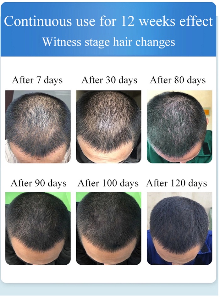 🔥Hot Sale🔥Pure Usma Grass Juice Hair Growth Solution /Genetic Hair Loss ...