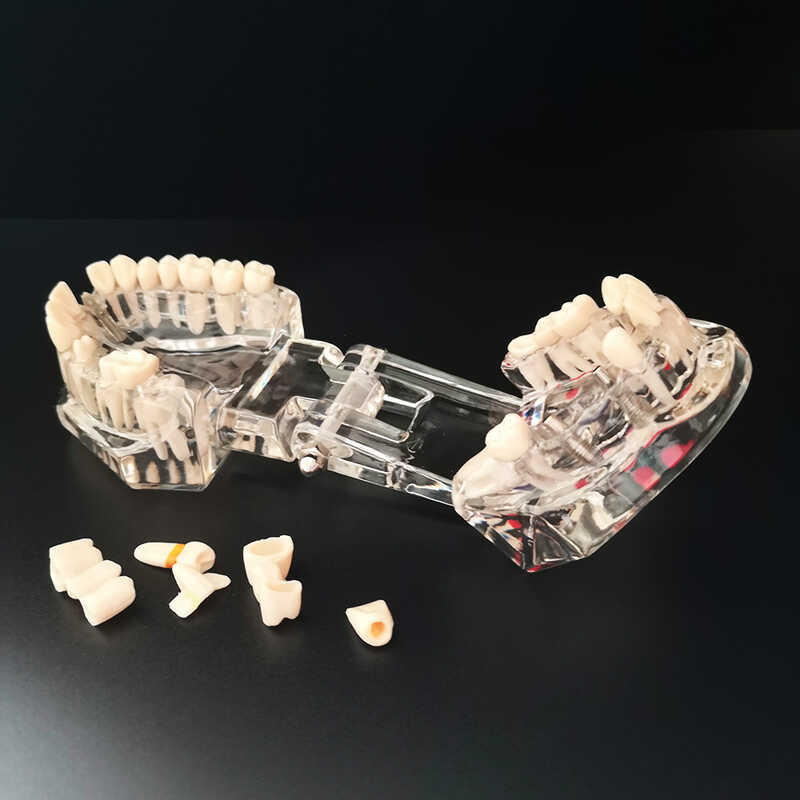 LY Teeth Model Dental Implant With Restoration Bridge Dentist Disease ...