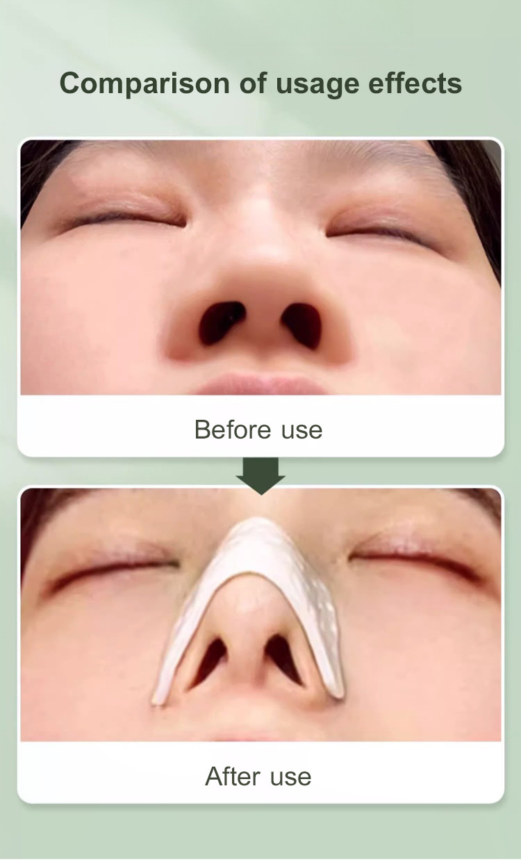 Nose Splint Nose Shaping Patch Nose Contouring Patch Nose Shaper Non ...
