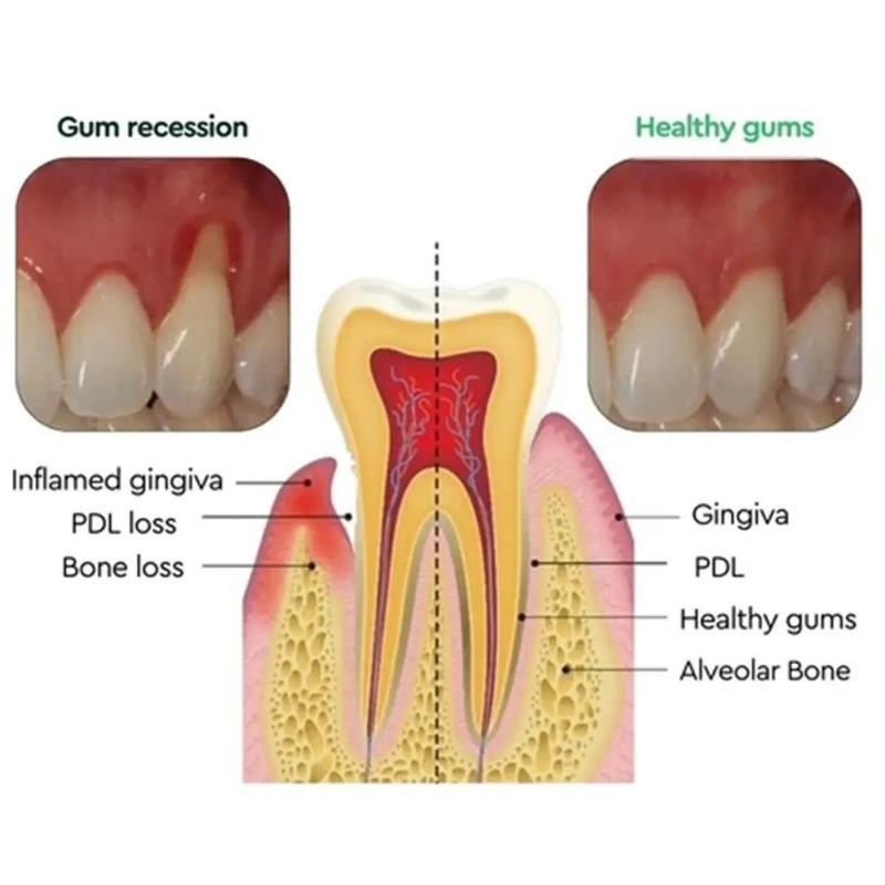 Gum Repair Drops Relieve Receding Gingival Swelling Gum Cleaning Care ...