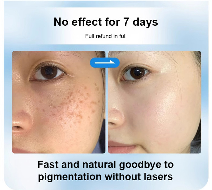 Freckle Removal Whitening and Anti-Freckle Cream /Improve Dullness and ...