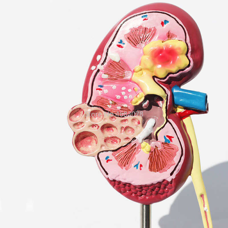 Human Body Organ Medical Kidney Anatomical Model Diseased Kidney Model ...