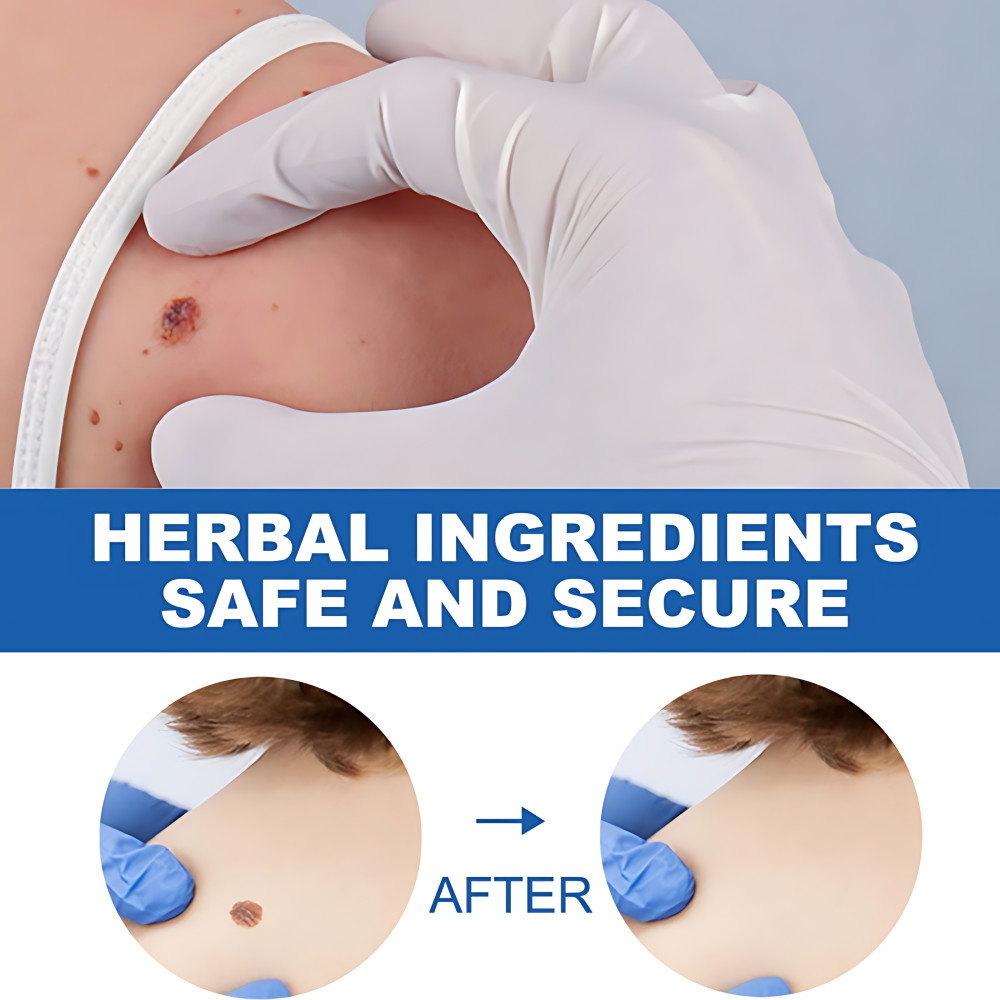 Tahi lalat remover Buang tahi lalat Buang kutil skin tag remover Remove ...