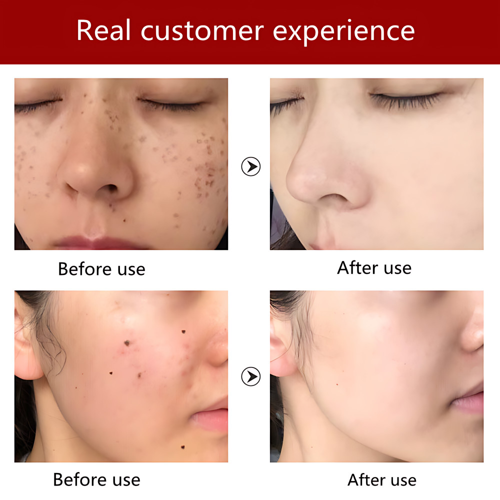 Tahi lalat remover Buang tahi lalat Buang kutil skin tag remover Remove ...