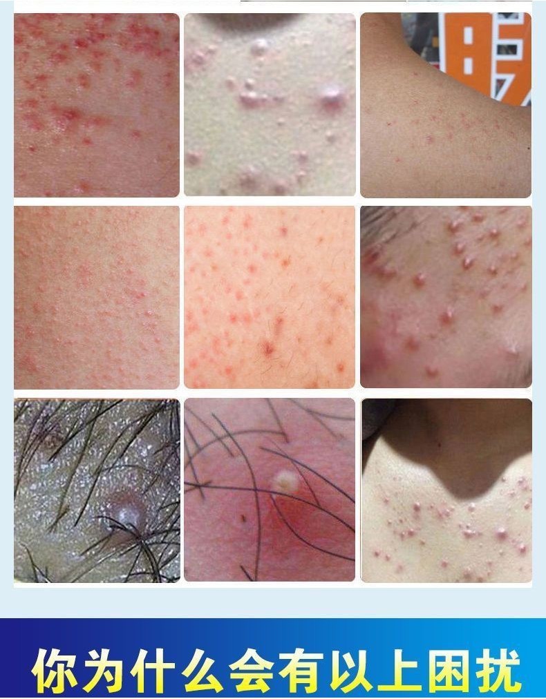 New Product#Folliculitis Ointment Special Effect Imported Head Face ...