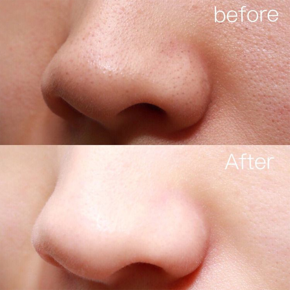 Face Skin Care Pore Cleaning Blackhead Comedone Acne Pimple Blemish ...