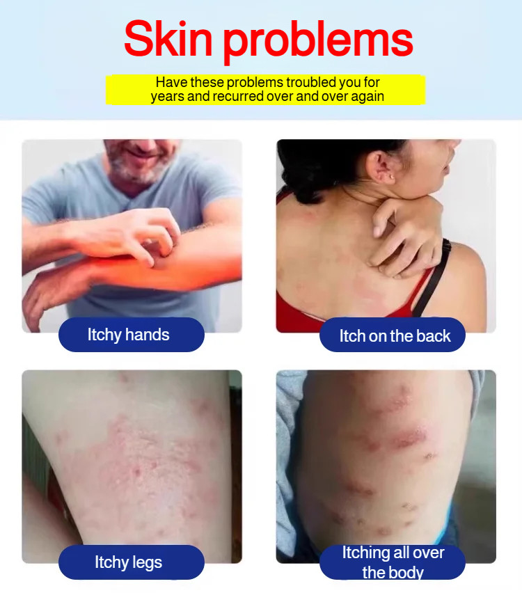 Longterm improvement Medical care Medical Dressing moisturize Eczema ...