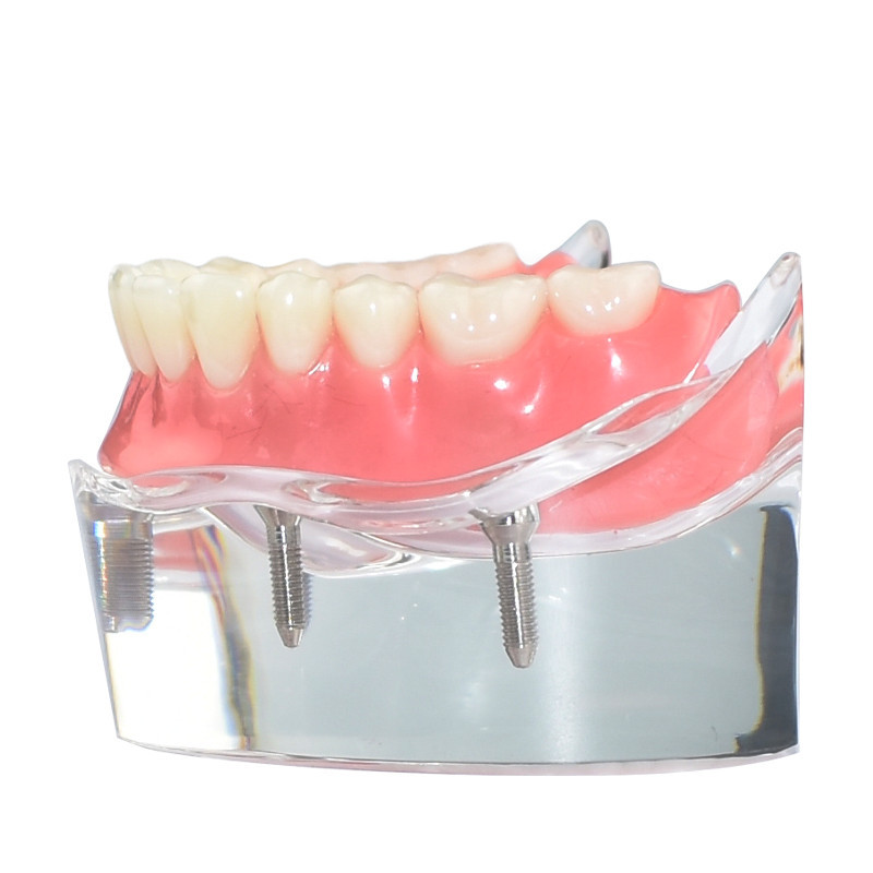 Dental Overdenture Tooth Model Removable Interior Mandibular Lower For ...