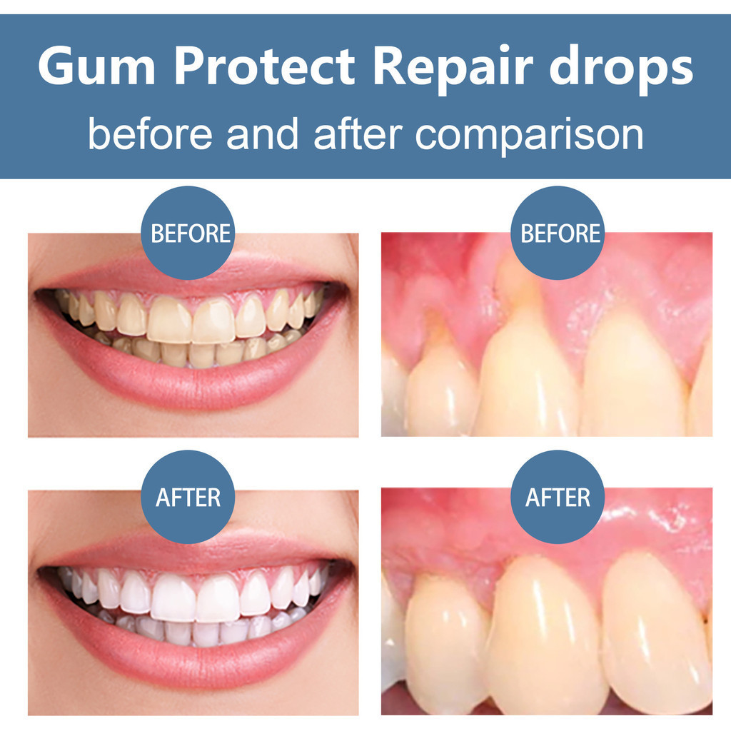 30ML Quickly Gum Repair Serum Drops Relief Periodontal Protect Gum ...