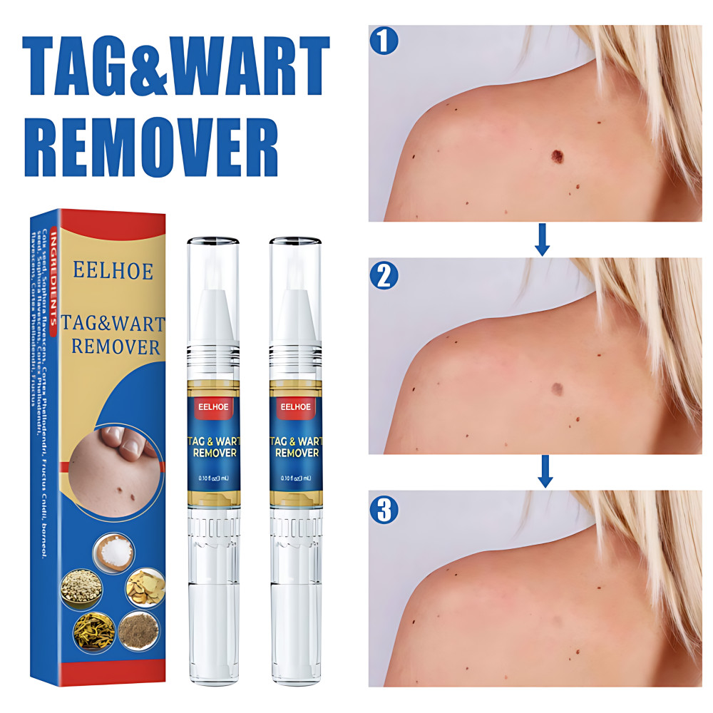 Tahi lalat remover Buang tahi lalat Buang kutil skin tag remover Remove ...