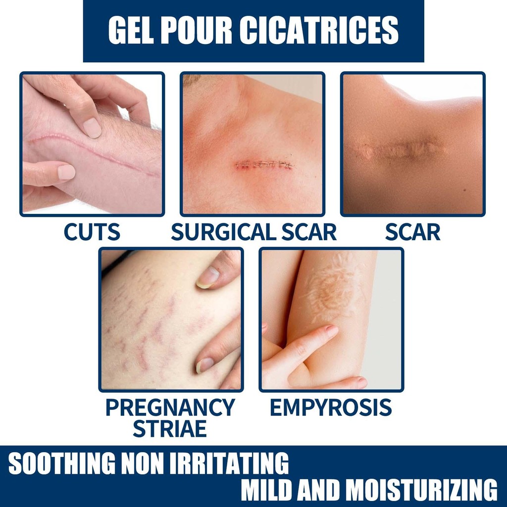 Scar Pen, Laser Treatment, Easy and Non-Fading, selesa, Increase Scar ...