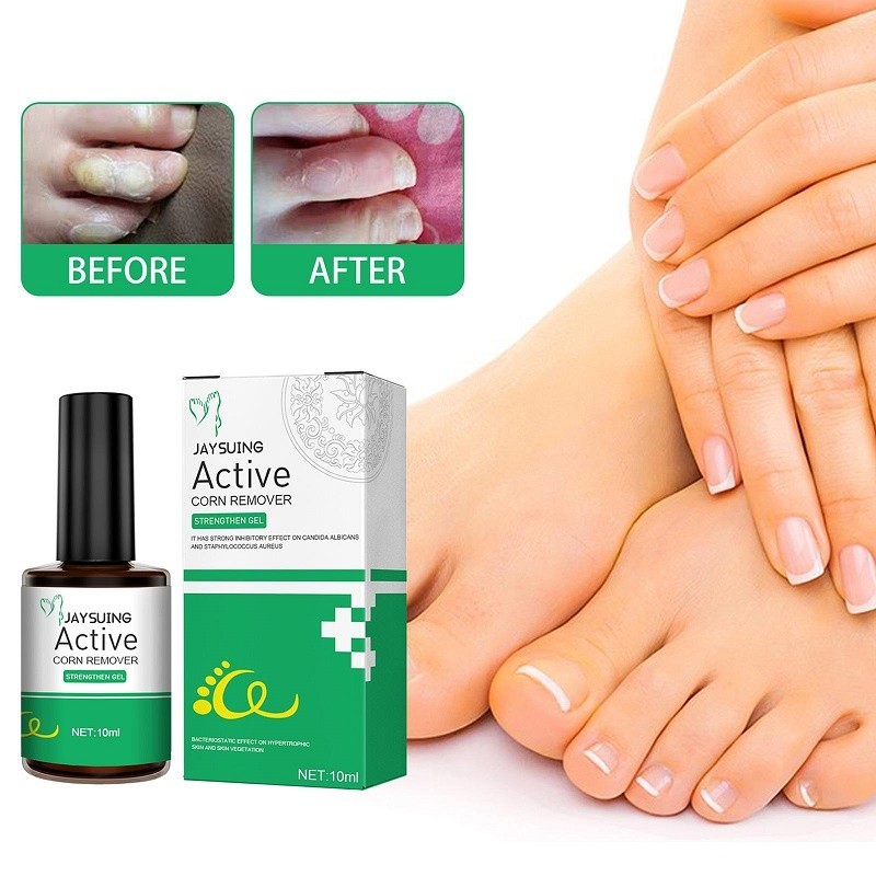 Effectively Remove Foot Corn Care Cream Remove Foot Calluses Remove ...