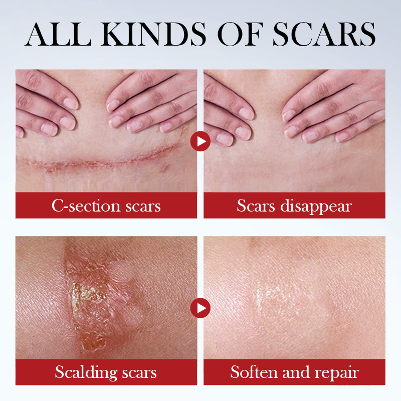 ROREC SADOER Repair Scar Cream Deep Repair Skin Smooth Tender External ...