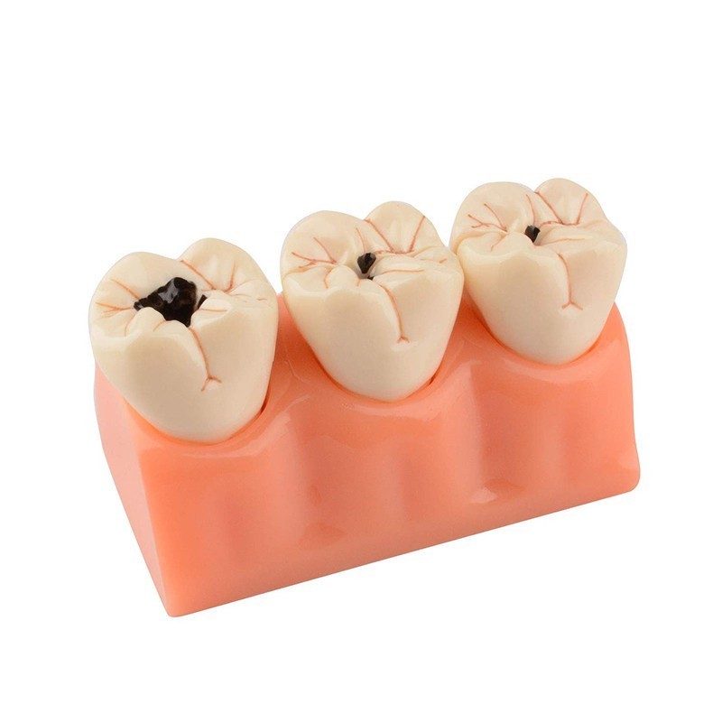 Dental Teeth Model Decayed Denture Caries Disease Tooth Model Decay ...