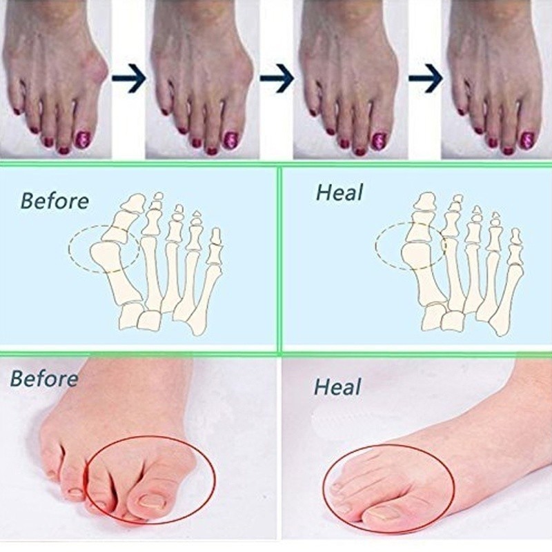 2pcs Feet Care Tool Toe Separator Overlapping Toes Rehabilitation ...