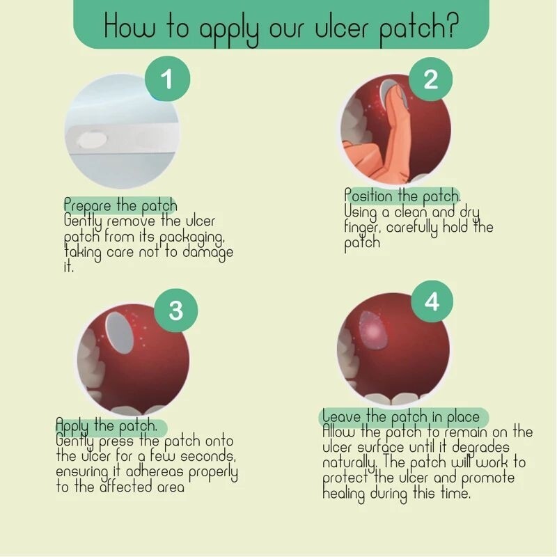 Mouth Ulcer Patch Pelekat Ulcer Mulut AcuMEDI Oral Ulcer Patch for ...