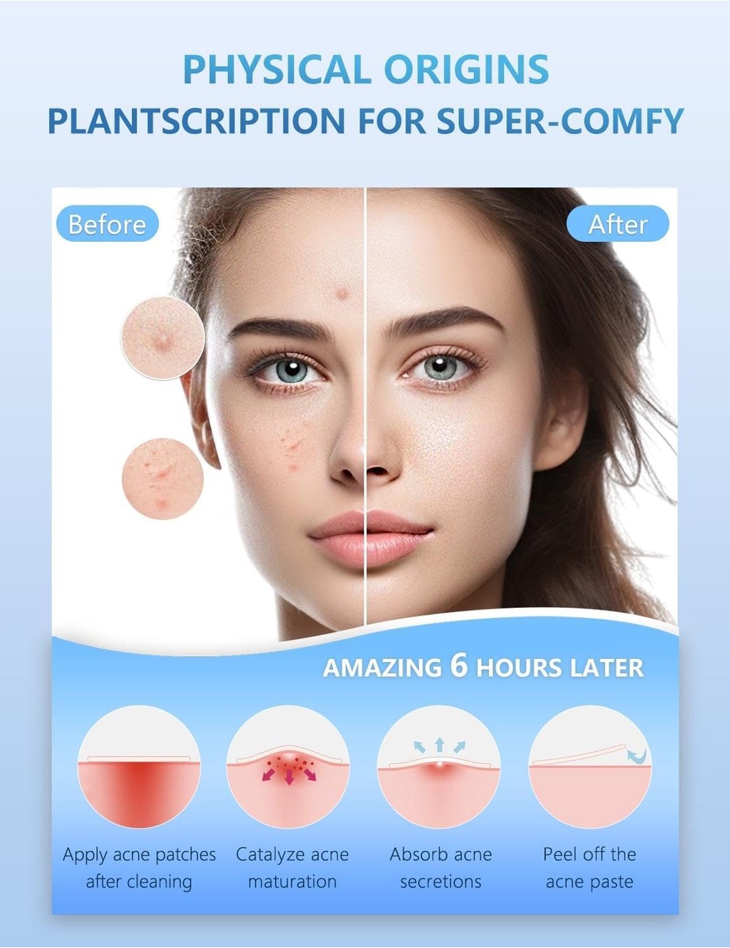 Suolaer Colorful Acne Pimple Patch Sticker Waterproof Removal Pimple ...