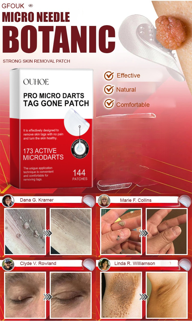 Plant Wart Removal wart cream wart patch Fade Chicken Eye Flesh Grain ...