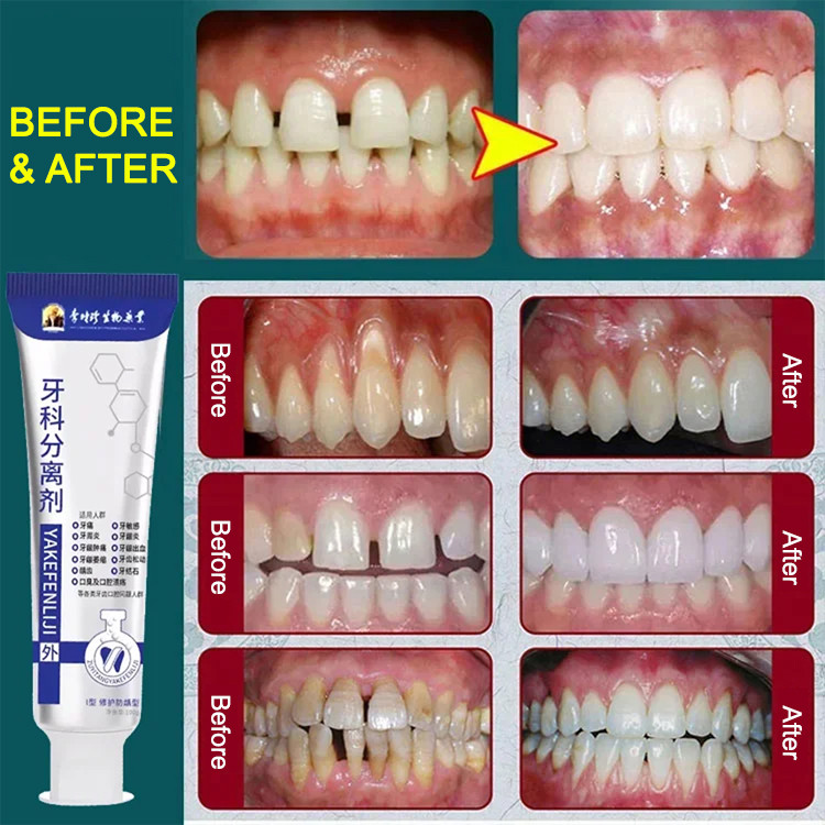 【100% Original Genuine】100g Tooth Separator Desensitizing Toothpaste ...