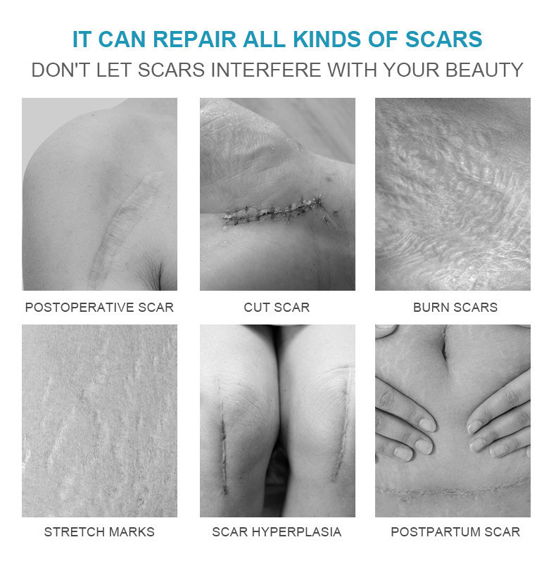 Scar Removal Cream Old Scar Cream Effective Repair New Scars Surgical ...