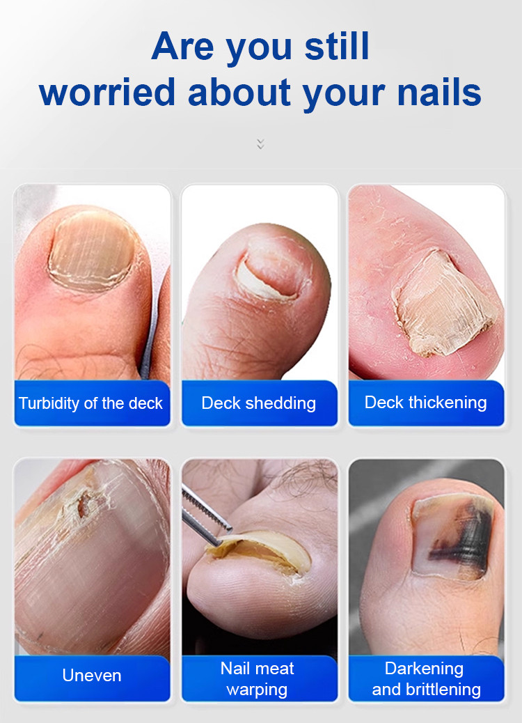 Repair damaged nails Nursing tablets Nail care tablets fragile Quickly ...