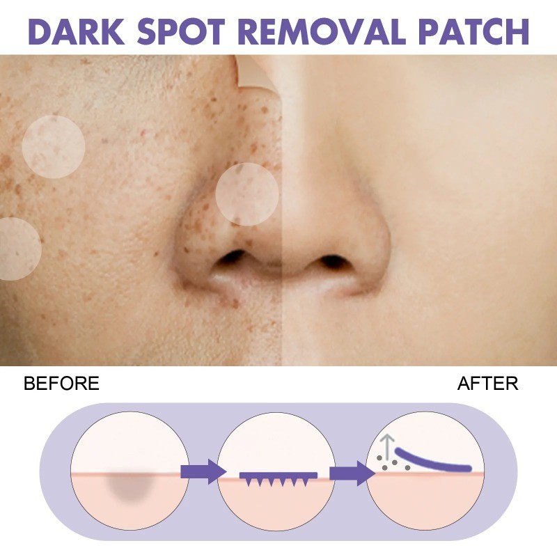 Face Spot Patches Freckle Removal Melanin Anti Pigmentation Lighten ...