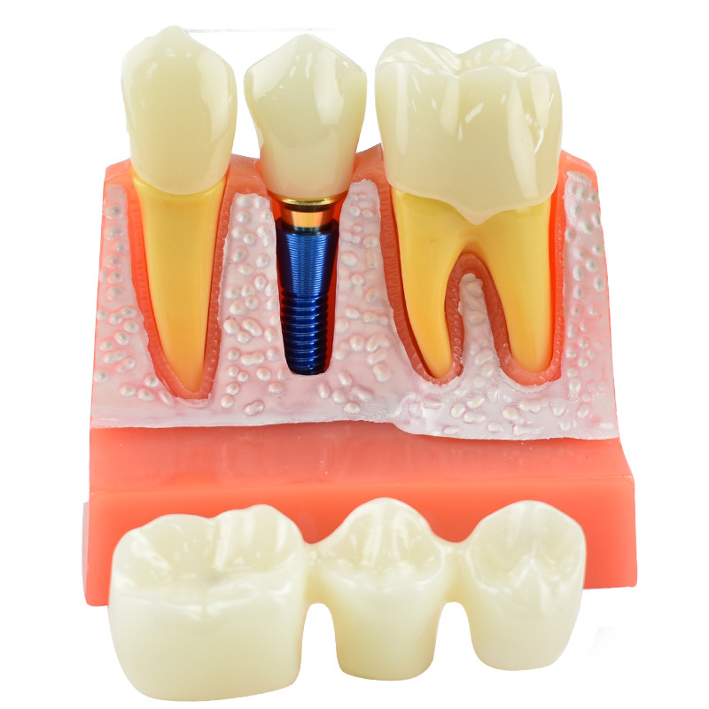 Dental Implant Teach Crown Bridge Removable Model Porcelain Teeth Model ...