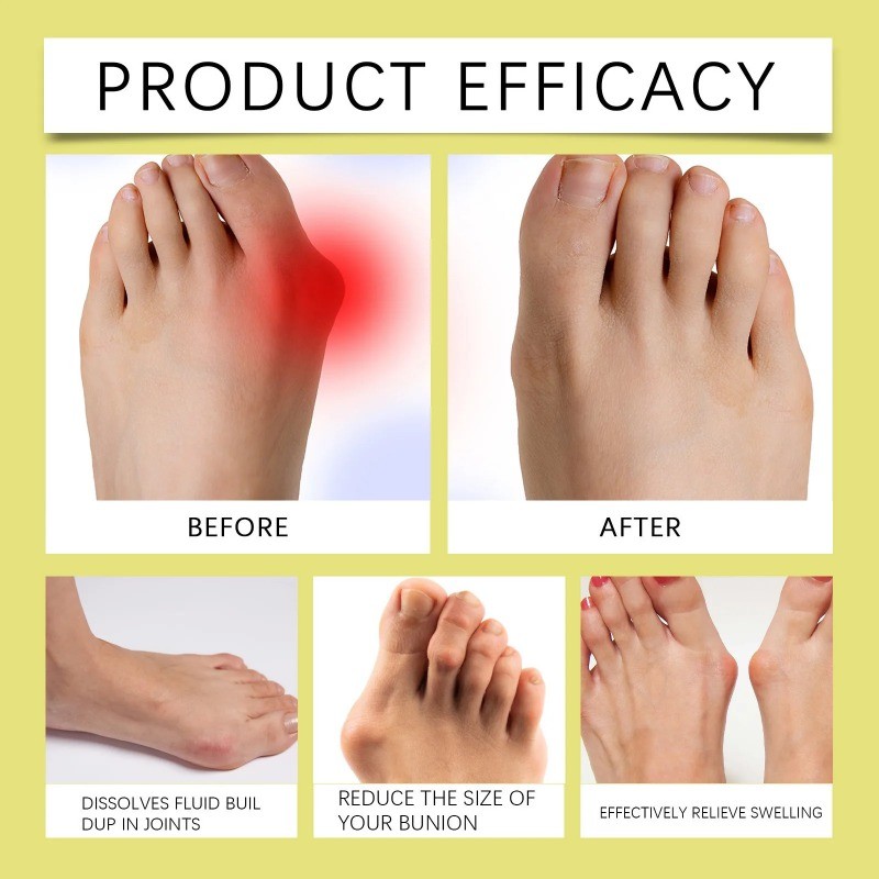 Toe Swelling Relief Cream Gout Treatment Hallux Valgus Corrector Finger ...