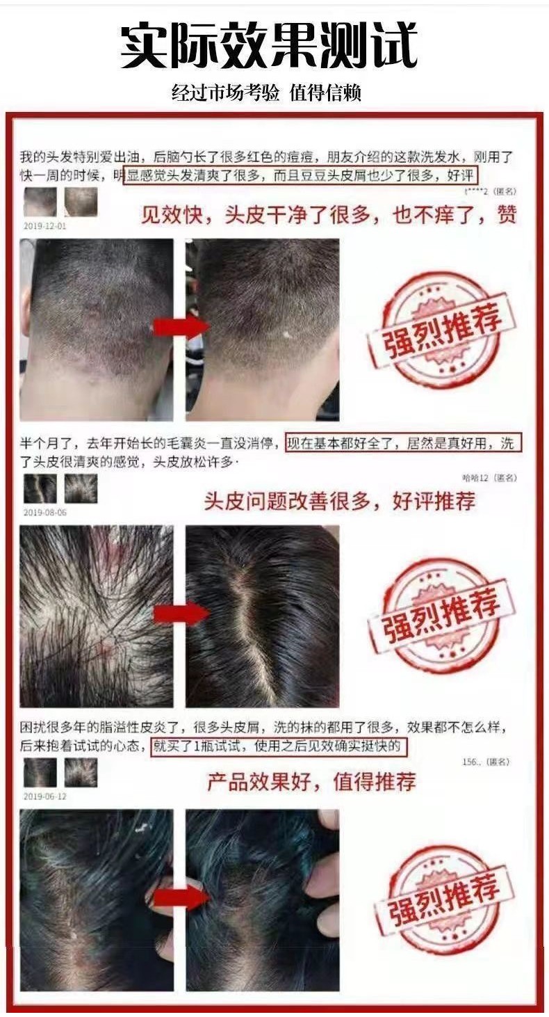 Selenium Disulfide Shampoo Mite Removal Shampoo Oil Control Shampoo ...