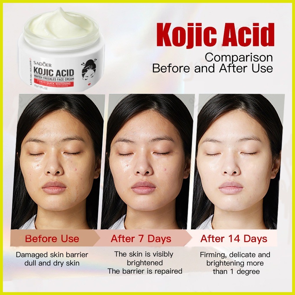 Kojic Acid Facial Cream Whitening Freckle Cream Melasma Cream Pekas ...