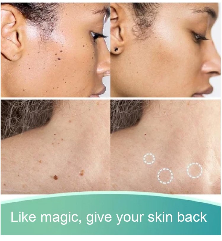 Sumifun Wart Cream for Removal of Warts and Corns | Shopee Malaysia