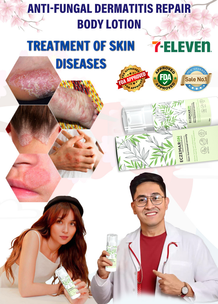 Body Milk Treatment Dermatitis Repair Antifungal | Shopee Malaysia