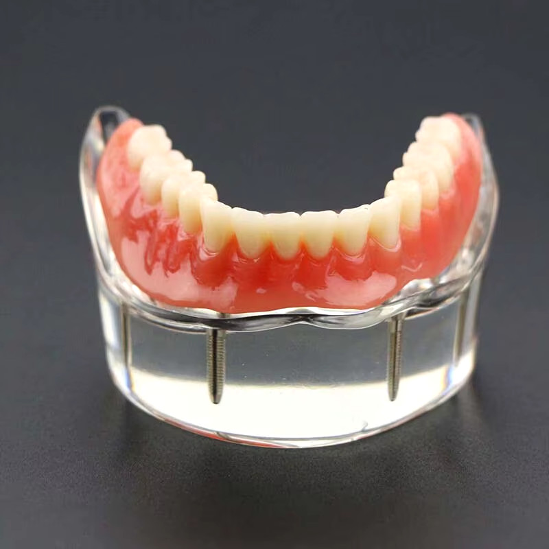 Dental Teeth Model with Implant Overdenture Model Inferior Demo Teeth ...