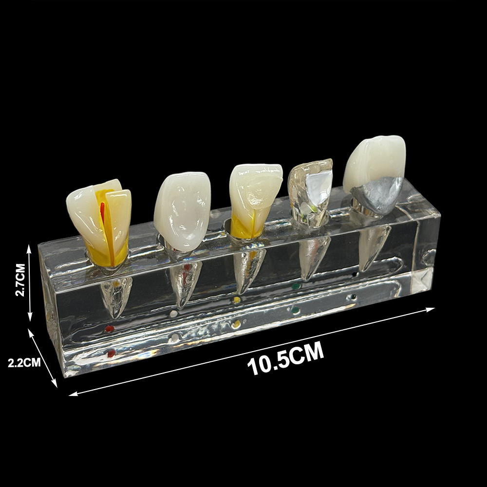 Dental Resin Teaching Model Endodontic Pathological Anterior Front ...