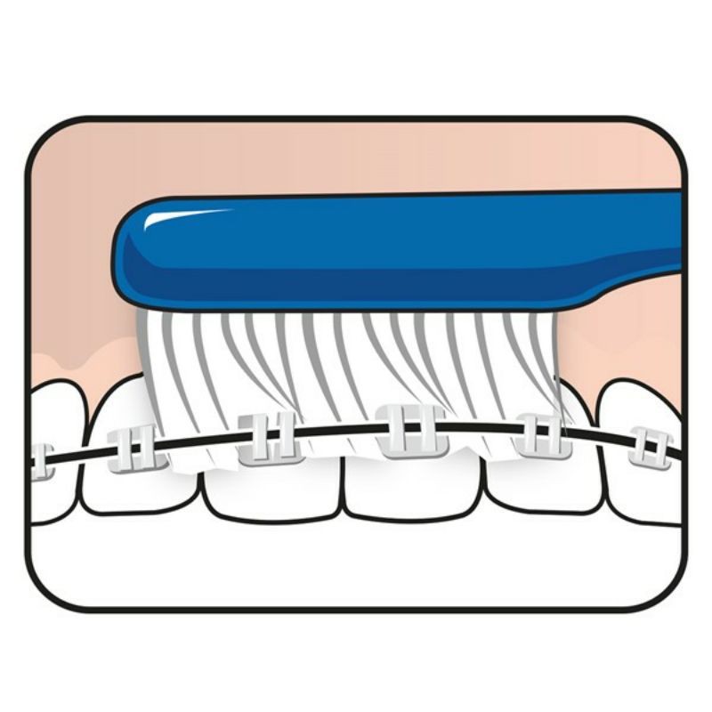 J13C Tepe Implant Orthodontic Toothbrush berus gigi braces toothbrush ...