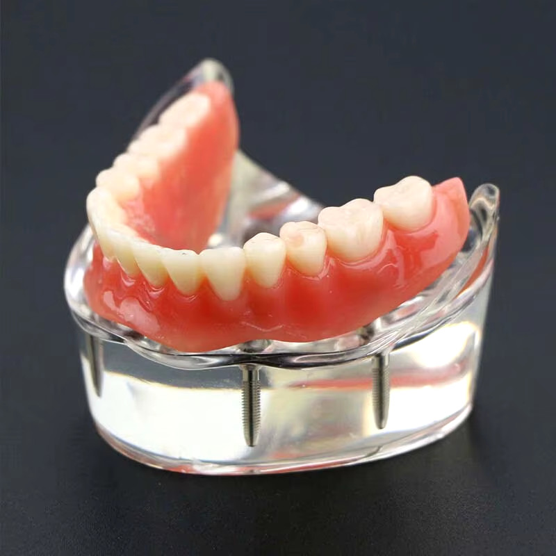Dental Teeth Model with Implant Overdenture Model Inferior Demo Teeth ...