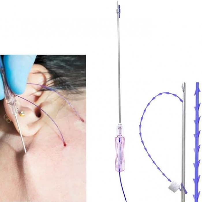 Minerva Fishbone Pdo Threads for Face lift - PDO Cog Threads Whole Body Lifting - Bullet Blunt ...