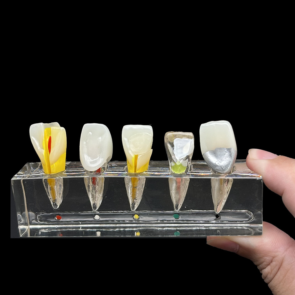 Dental Resin Teaching Model Endodontic Pathological Anterior Front ...