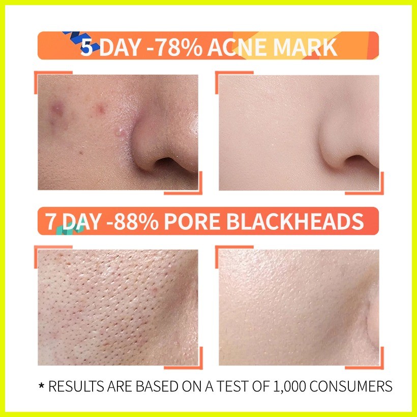 The Ordinary AHA 30% + BHA 2% Peeling Solution Pore Minimizer Blackhead ...