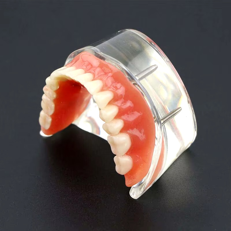 Dental Teeth Model with Implant Overdenture Model Inferior Demo Teeth ...