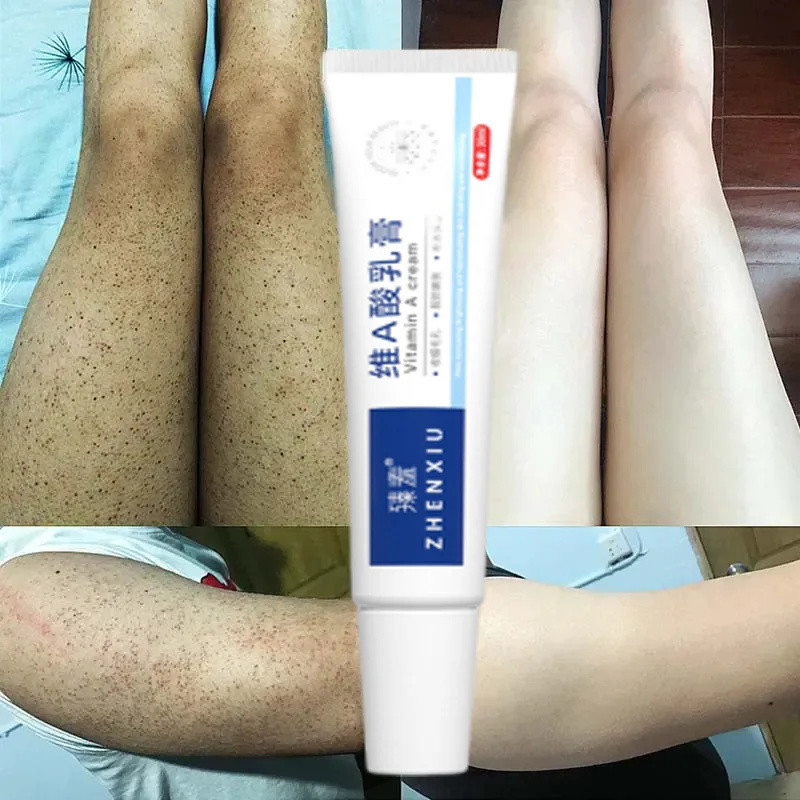 Body Whitening Cream Keratosis Pilaris Treatment Bumpy Rough Chicken ...
