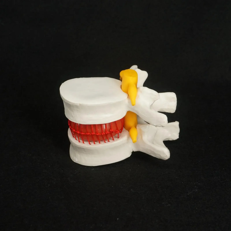 PVC Anatomical Herniated Lumbar Vertebrae Disc Prolapse Model Human ...