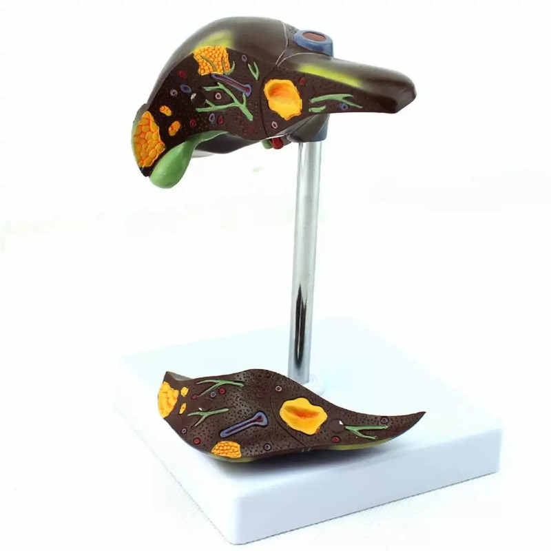 PVC Human Pathological Fatty Liver Cirrhosis Hepatitis Model Medical ...