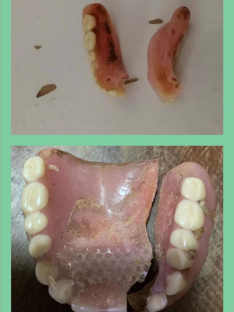 Movable Denture Glue Denture Falling off Sticky Teeth Broken Denture ...