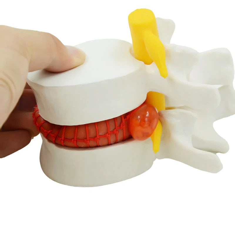 Human Anatomy Skeleton Spine Lumbar Disc Herniation Teaching Model ...