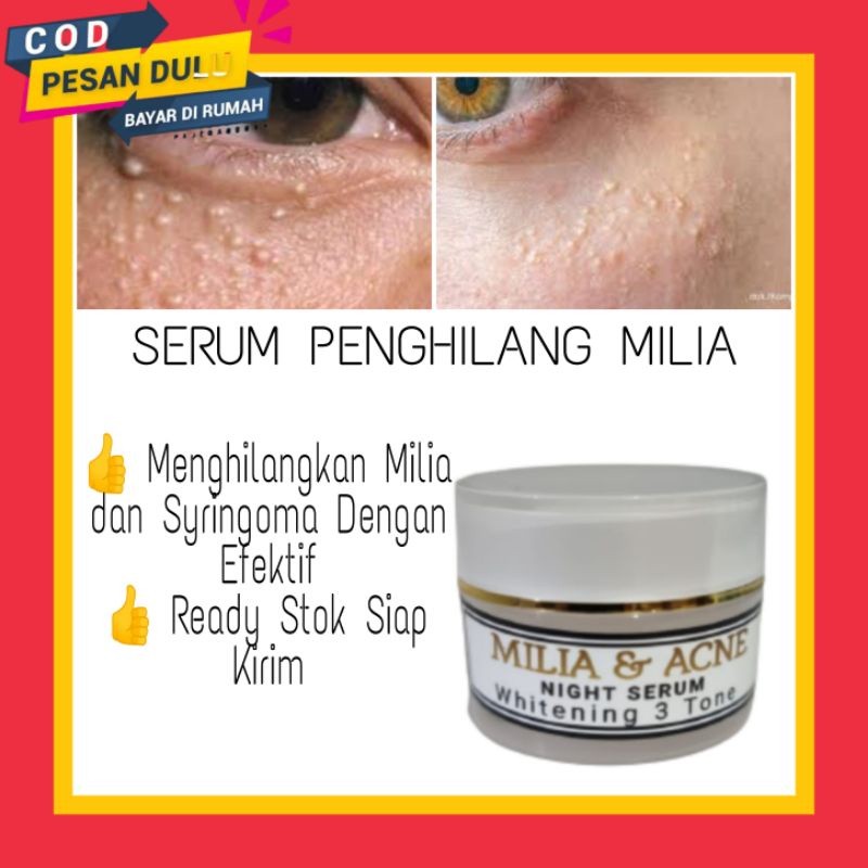 in stock PUTIH MATA White Spot Milia Removal Medicine Under The Eyes ...