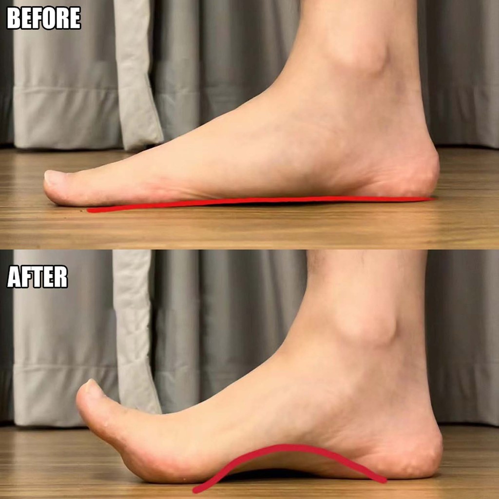 Universal Adjustable Orthotic Insole - Durable PU Skin Tone Flat Foot ...