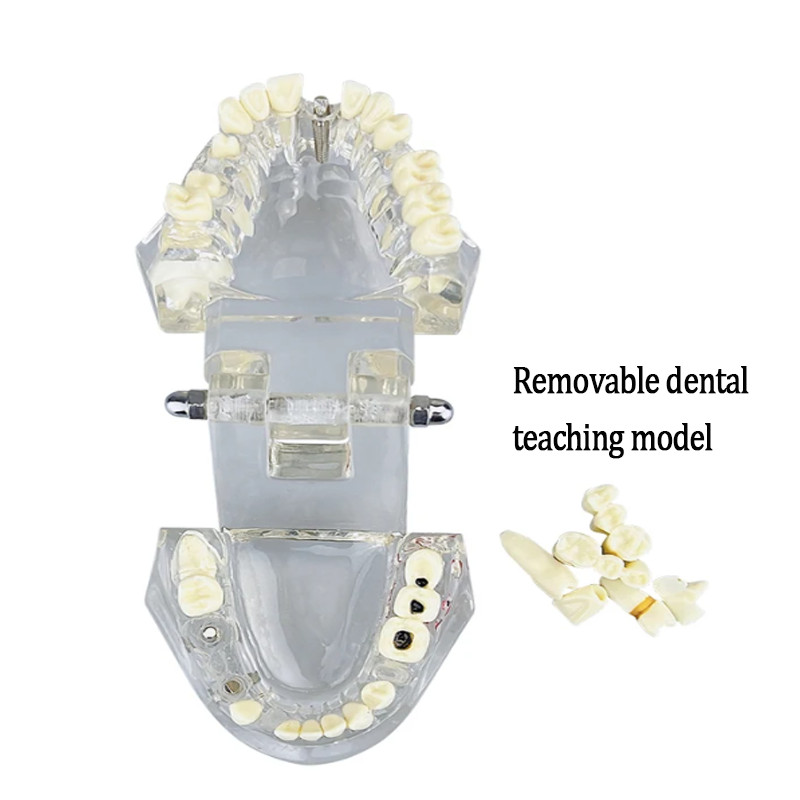 Dental Transparent Disease Typodont Implant With Removable Tooth ...