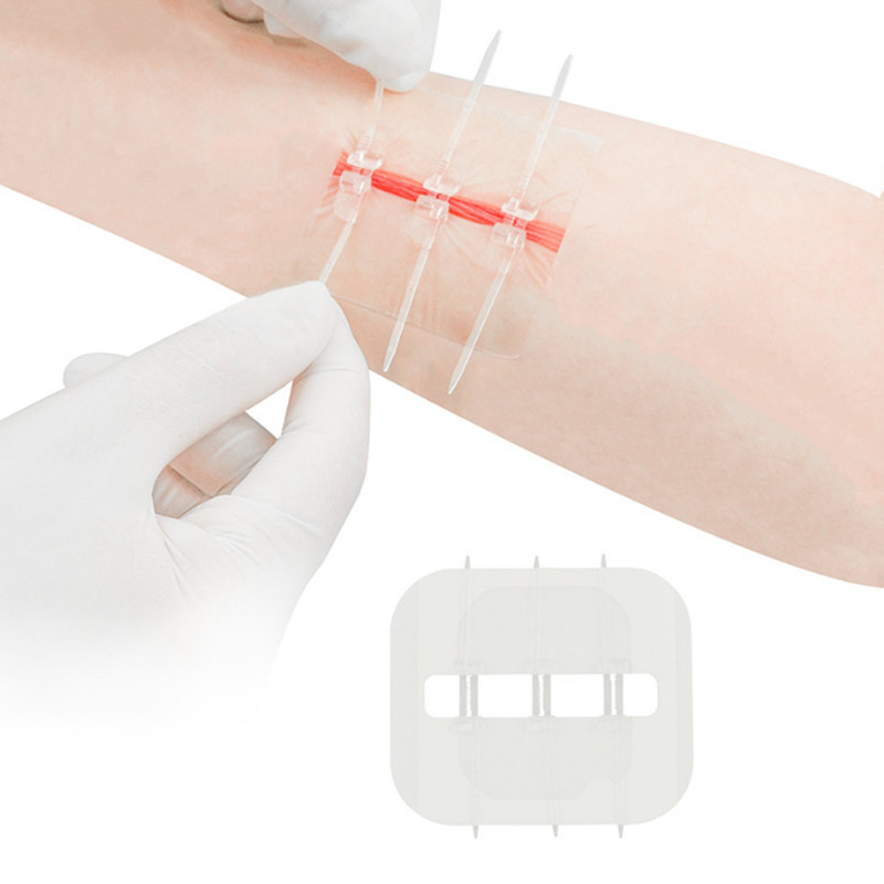 Zipper Band-aid Wound Closure Device Outdoor Portable Hemostatic ...