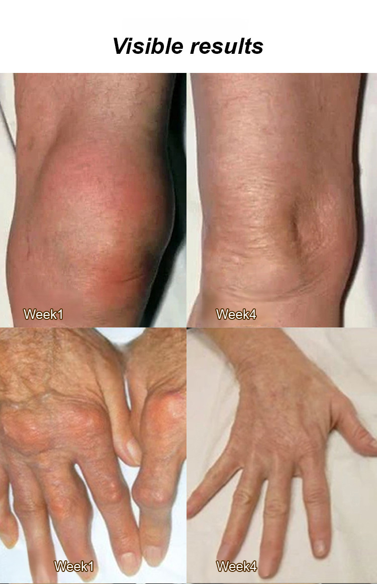 Japanese Mitsui Gout Foot Needle Patch For Uric Acid Redness And Joint ...